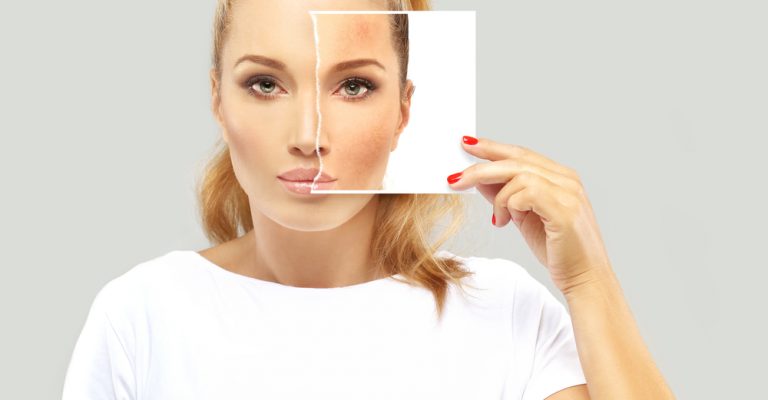 The 10 Best Freckle Removal Creams and Treatments to Buy in 2026